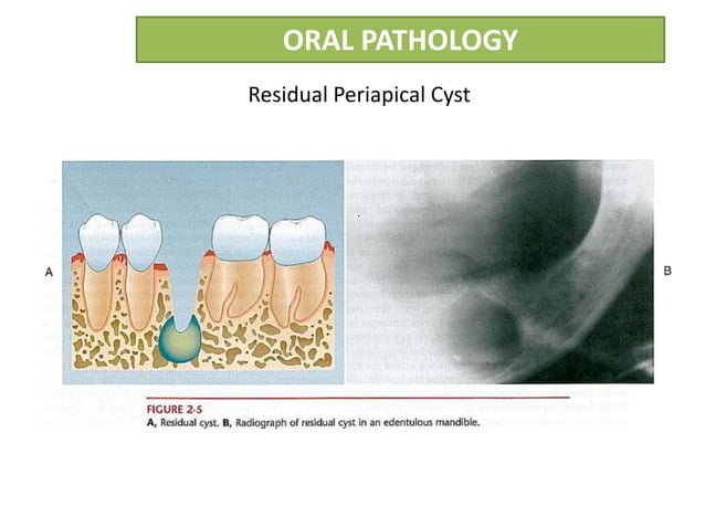 Radicular cyst or Periapical cyst | PPTX