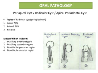 Radicular cyst or Periapical cyst | PPTX