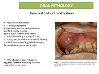 Radicular cyst or Periapical cyst | PPTX