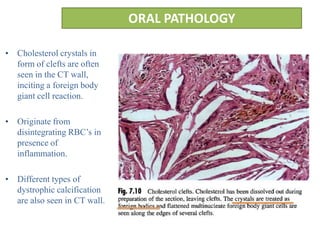 Radicular Cyst Histology