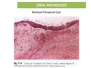 Residual Cyst Histology