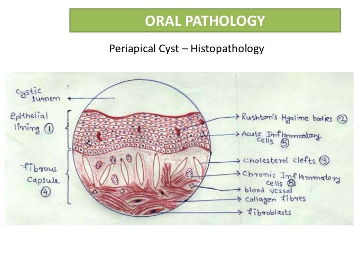Radicular cyst or Periapical cyst