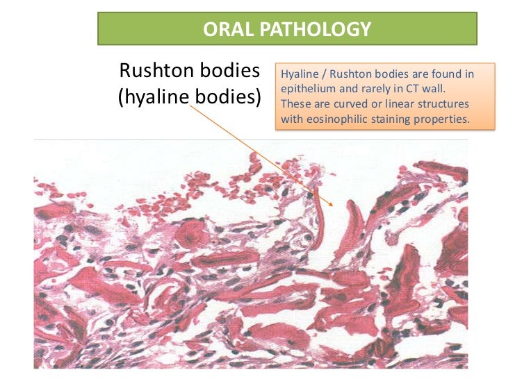 Radicular cyst or Periapical cyst