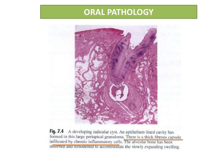 Radicular cyst or Periapical cyst