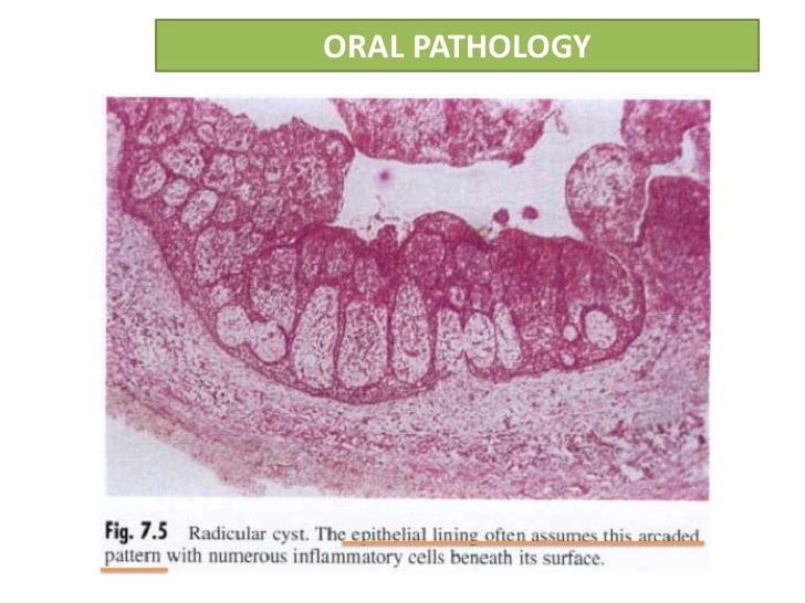 Radicular cyst or Periapical cyst