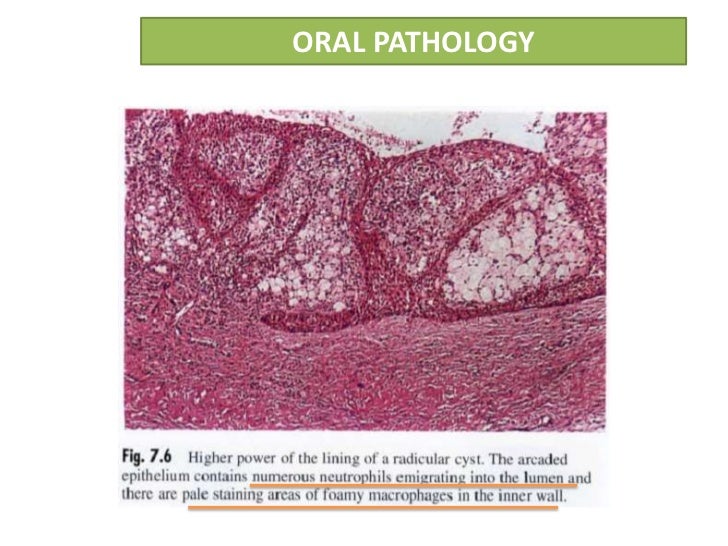 Periapical Cyst Histology Dental Update Odontogenic Cysts – An