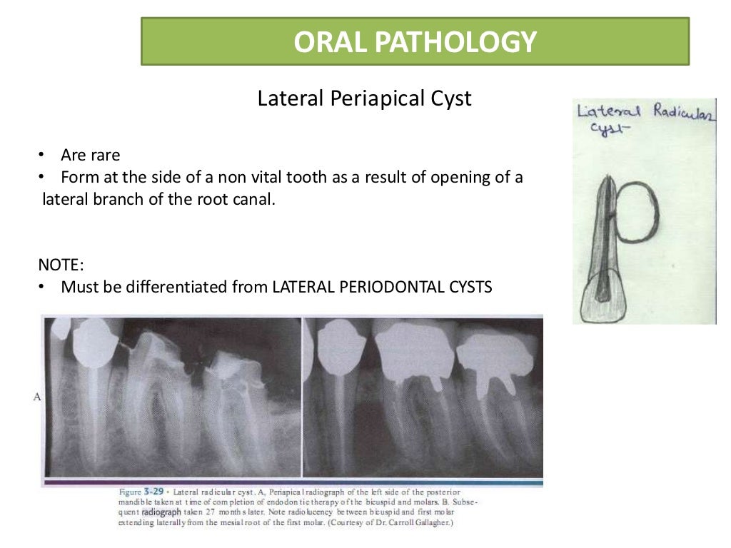 Radicular cyst or Periapical cyst