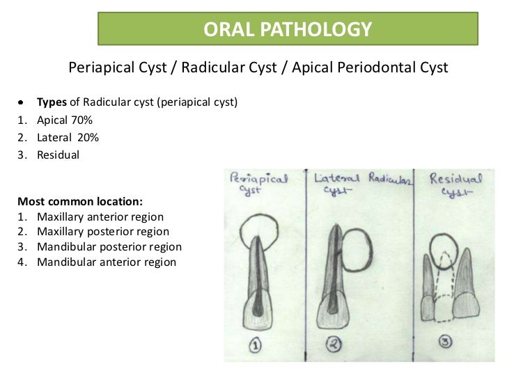 Radicular cyst or Periapical cyst
