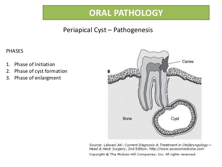 Radicular cyst or Periapical cyst