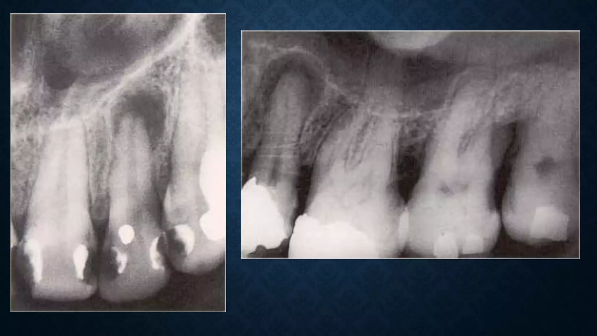 Radicular cyst | PPTX
