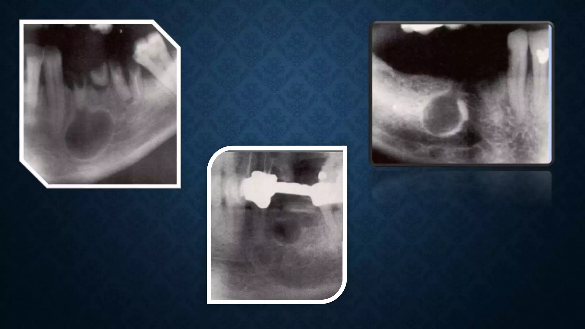 Radicular cyst | PPTX