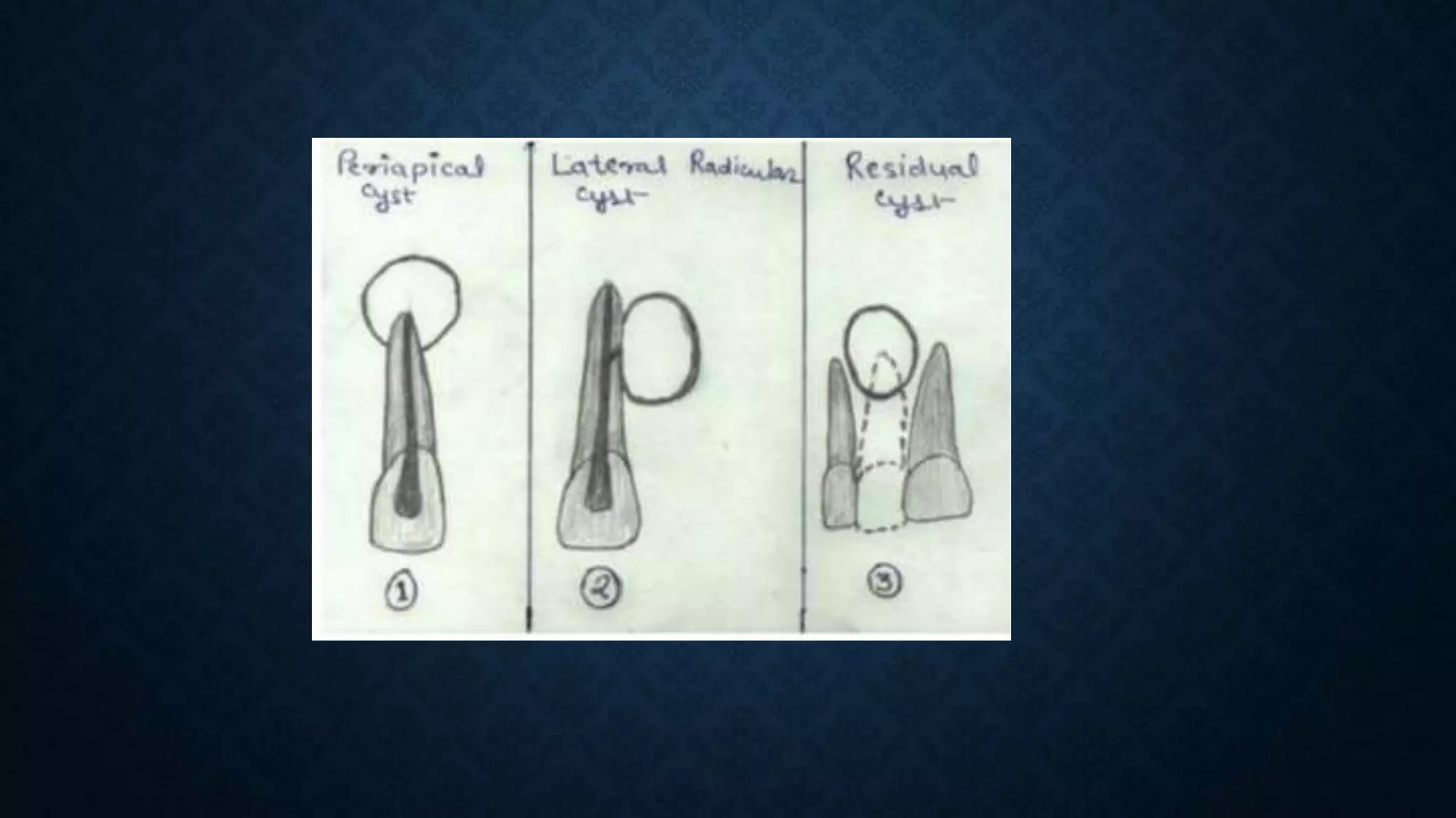 Radicular cyst | PPTX