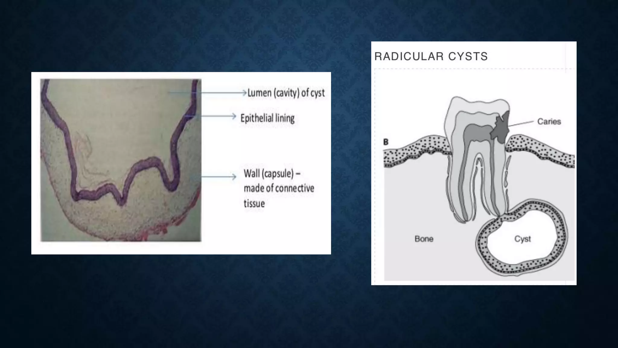 Radicular cyst | PPTX