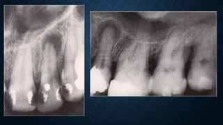 Radicular cyst | PPTX
