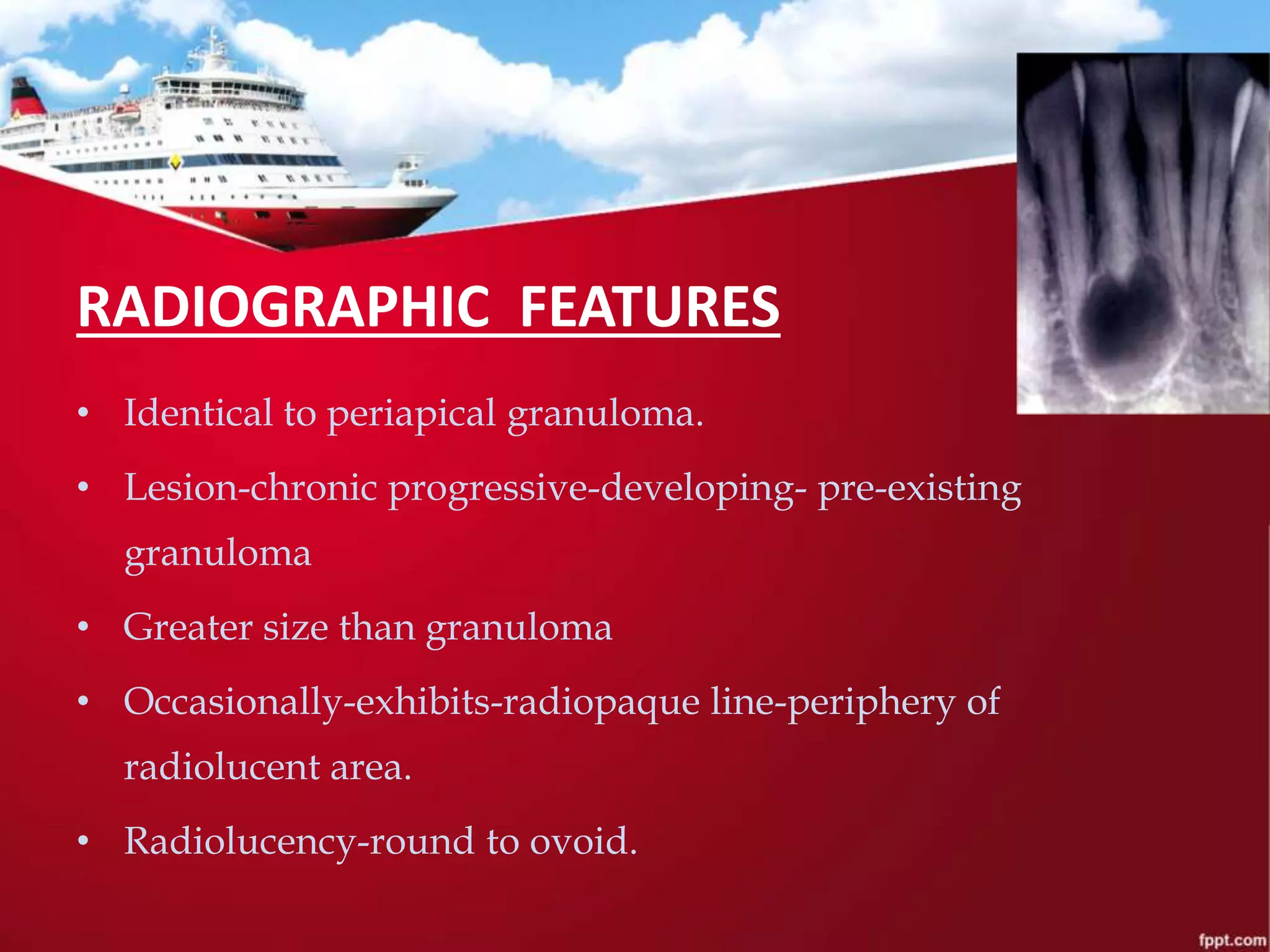 Radicular cyst | PPTX