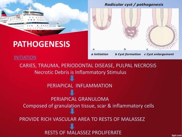 Radicular cyst | PPTX