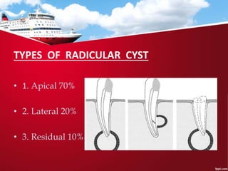 Radicular cyst | PPTX