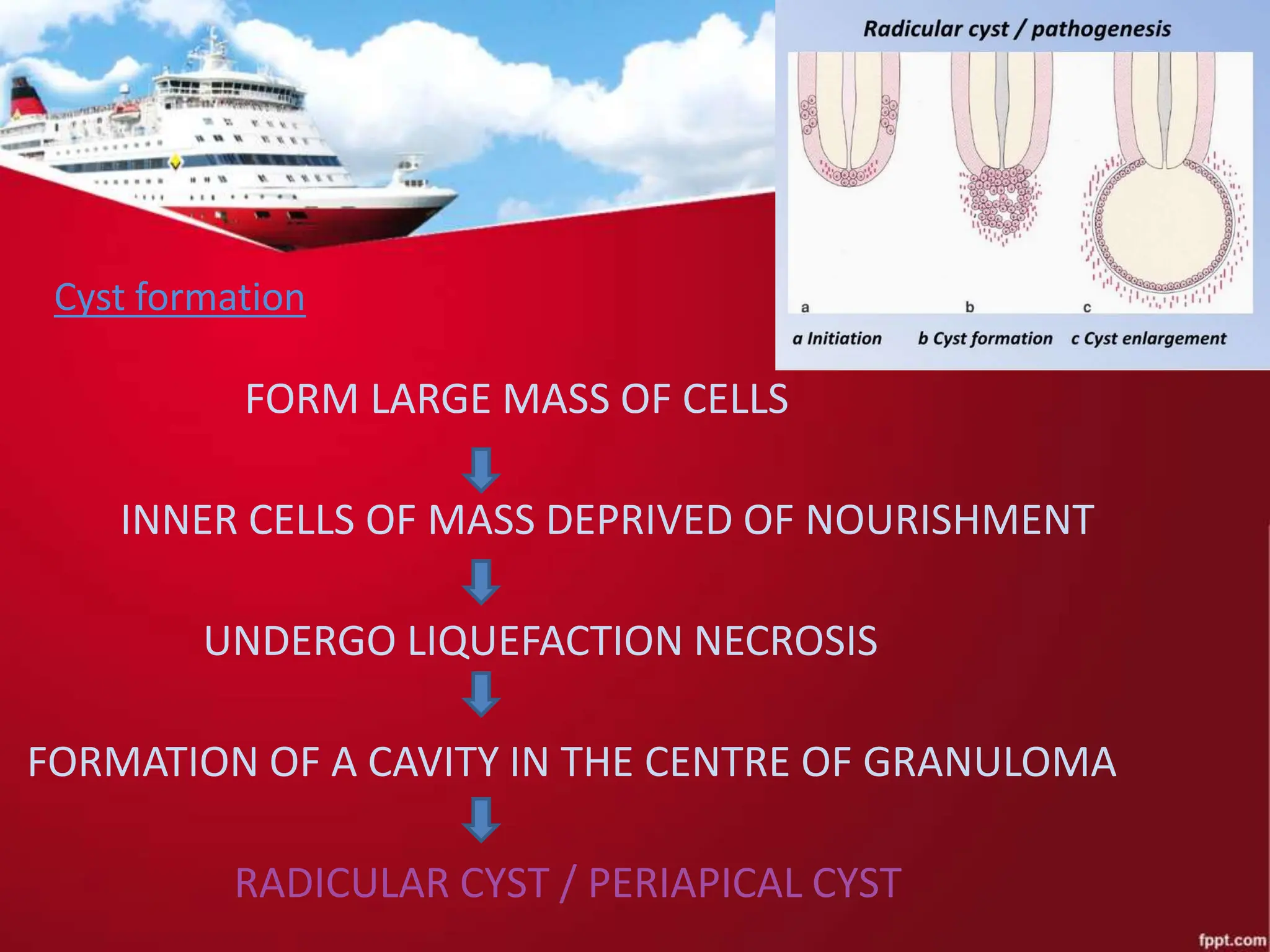 radicularcyst histology treatment n prognosis | PPTX
