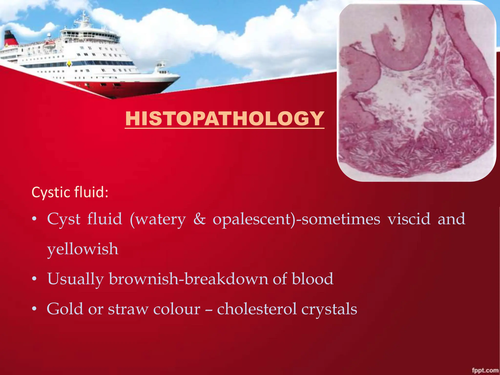 radicularcyst histology treatment n prognosis | PPTX