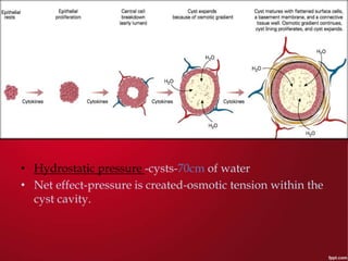 radicularcyst histology treatment n prognosis | PPTX