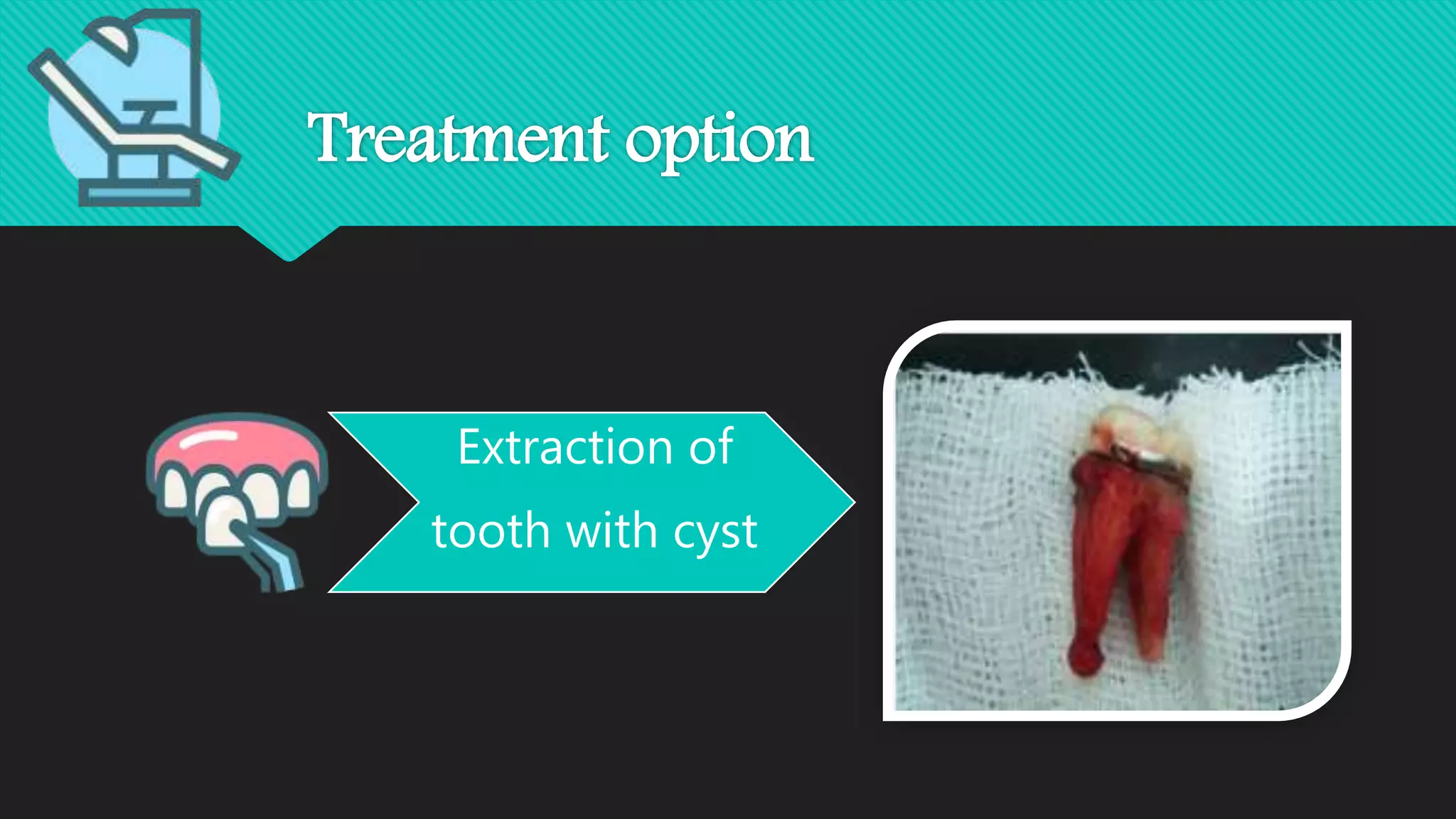 Radicular cyst | PPTX