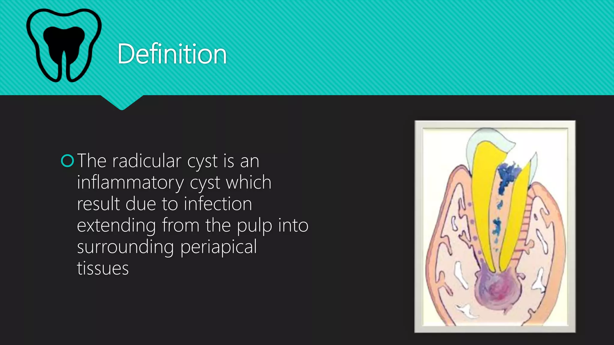 Radicular cyst | PPTX