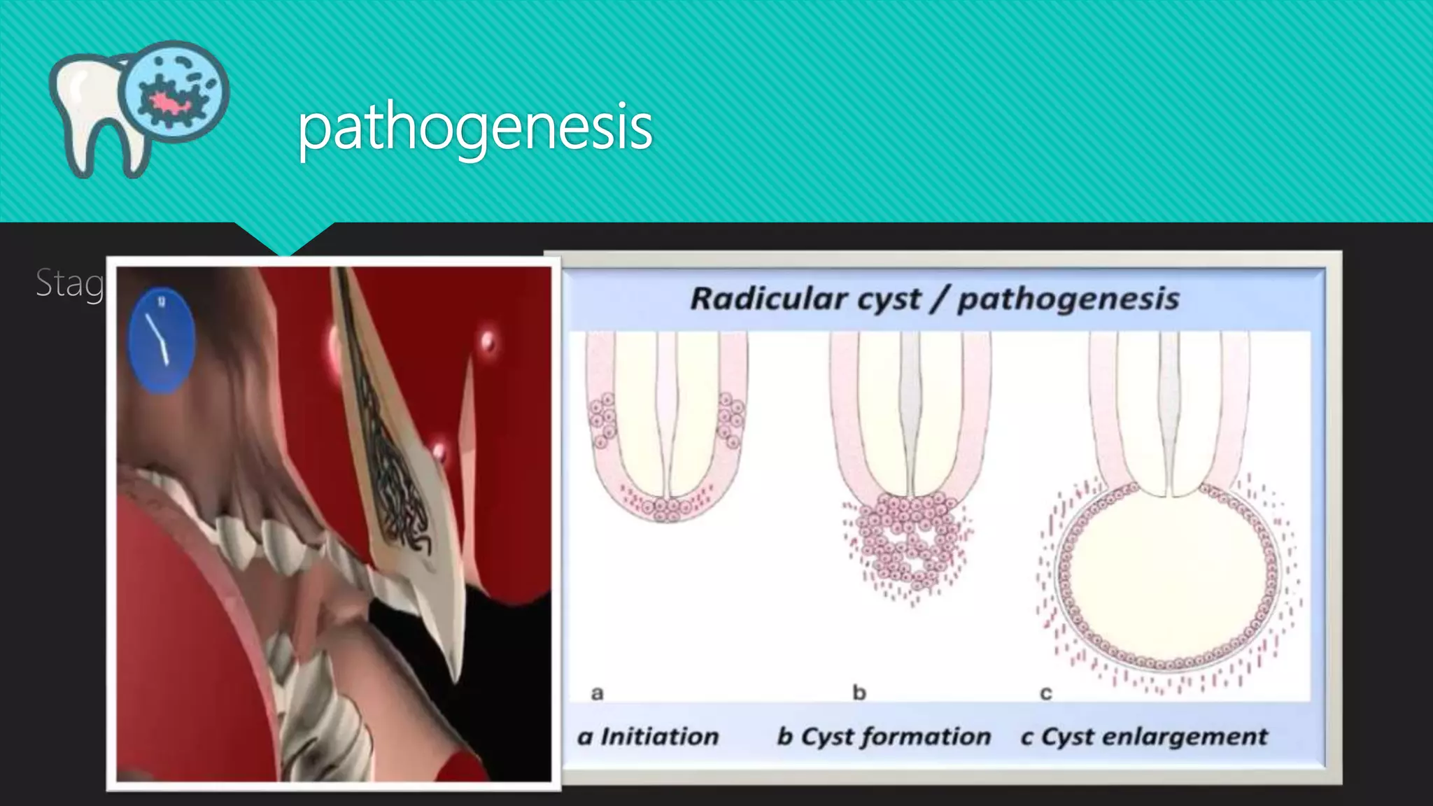 Radicular cyst | PPTX