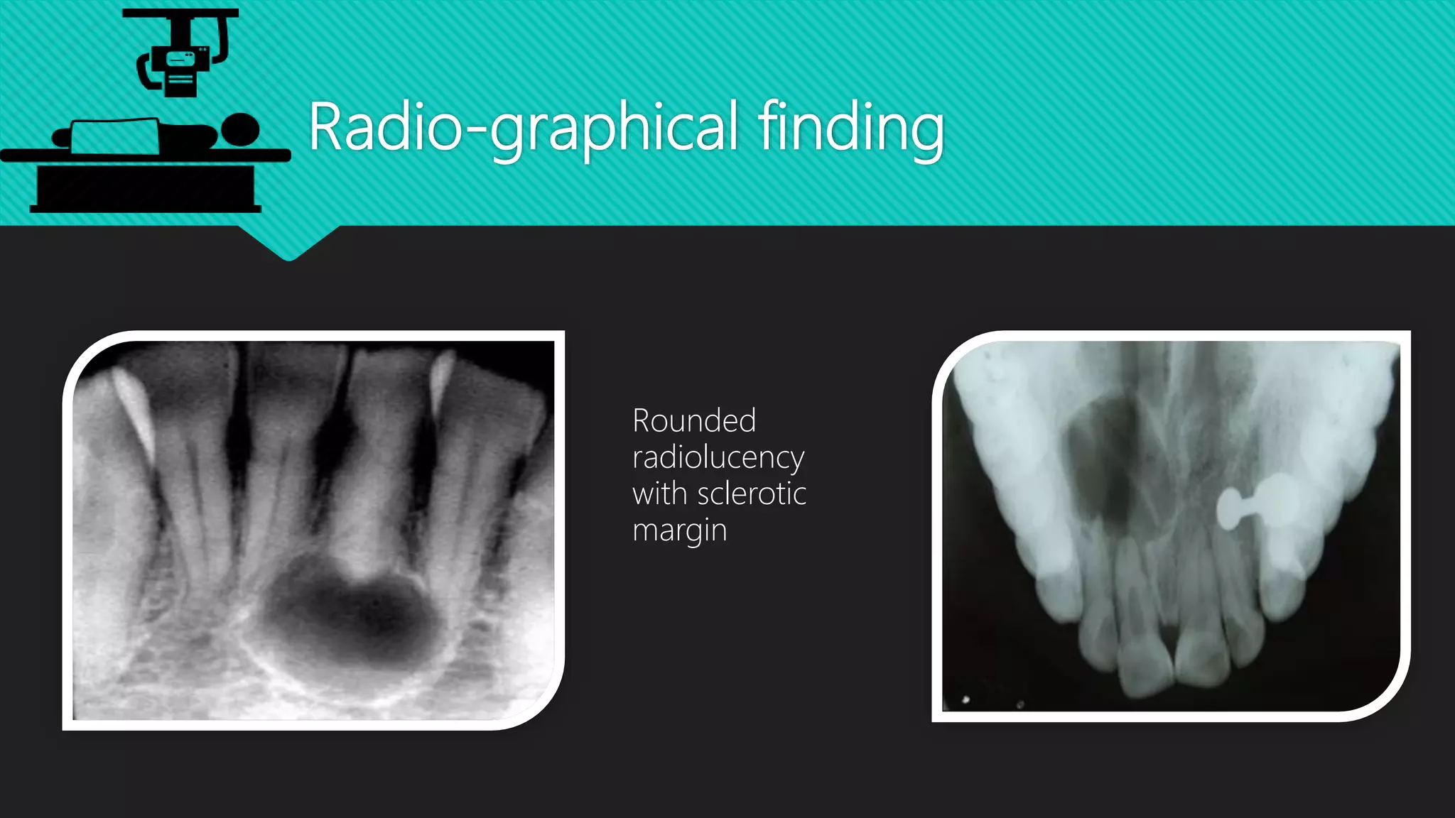Radicular cyst | PPTX