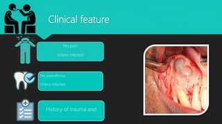 Radicular cyst | PPTX