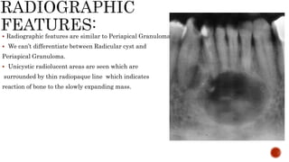 Radicular cyst or periapical odontogenic cyst | PPTX