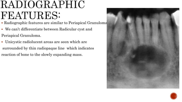 Radicular cyst or periapical odontogenic cyst | PPTX