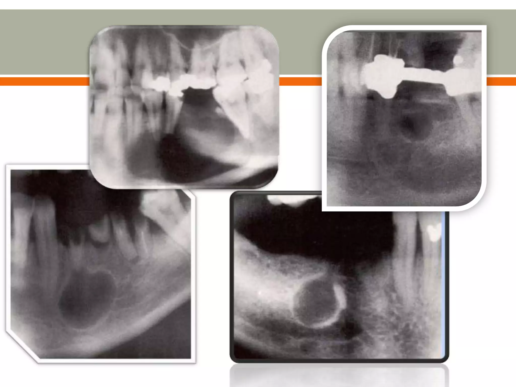 Radicular cyst | PPTX