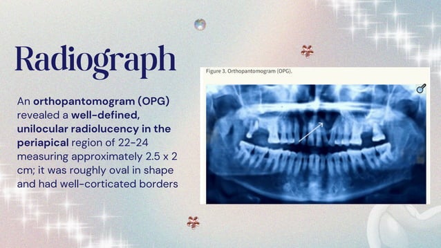 Radicular Cyst Case Presentation - Dentistry.pdf