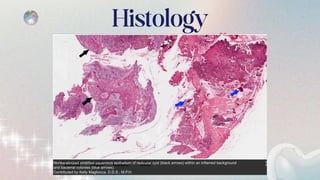 Radicular Cyst Case Presentation - Dentistry.pdf