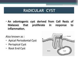 radicular cyst.............................. | PPTX