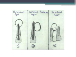 radicular cyst.............................. | PPTX