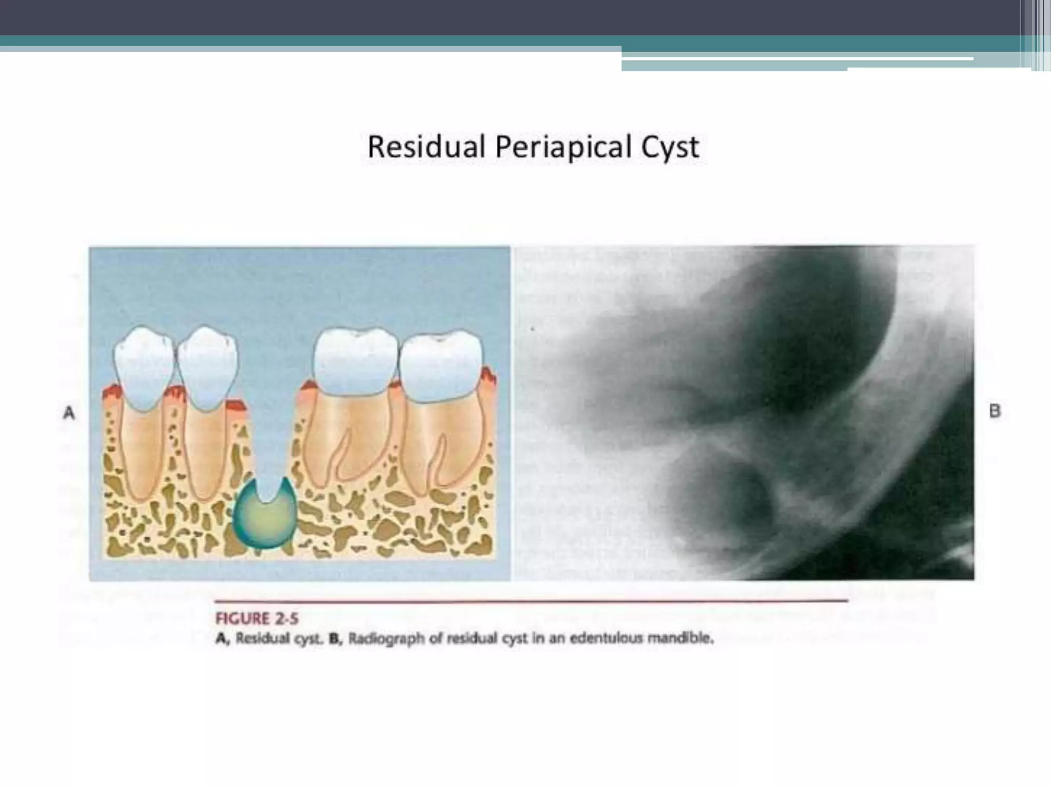 Radicular cyst (maryam arbab) | PPTX