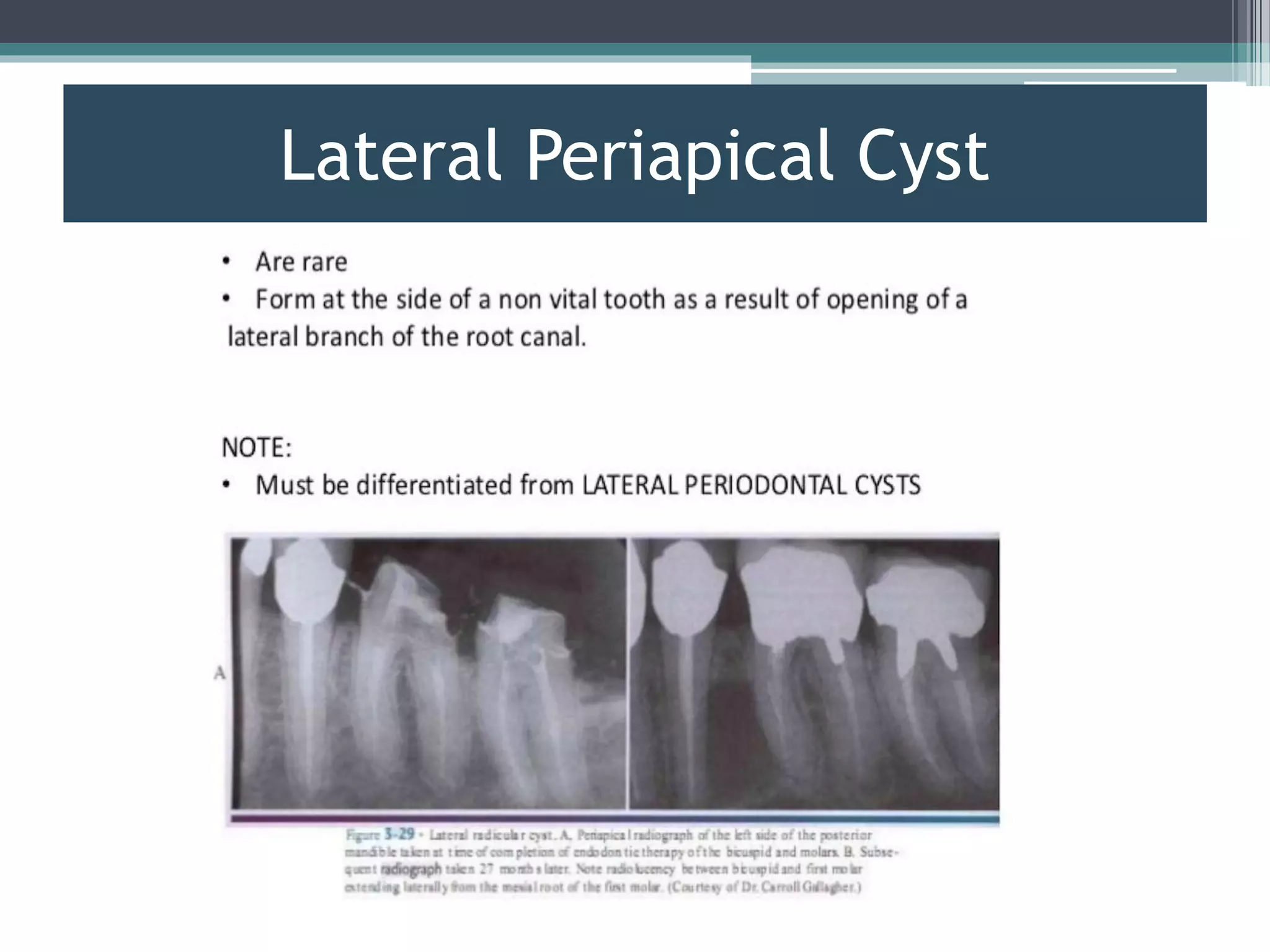 Radicular cyst (maryam arbab) | PPTX