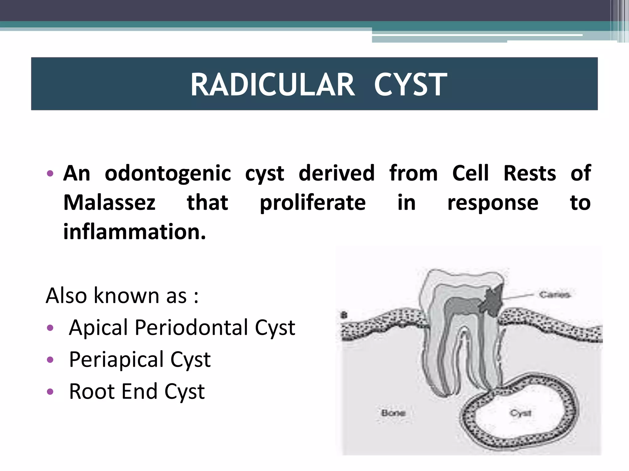 Radicular cyst (maryam arbab) | PPTX