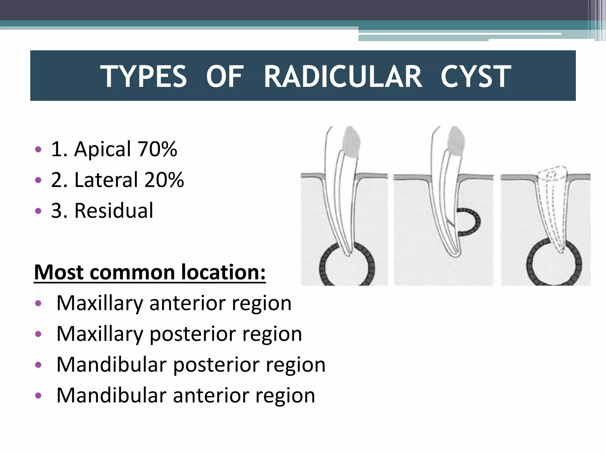 Radicular cyst (maryam arbab) | PPTX