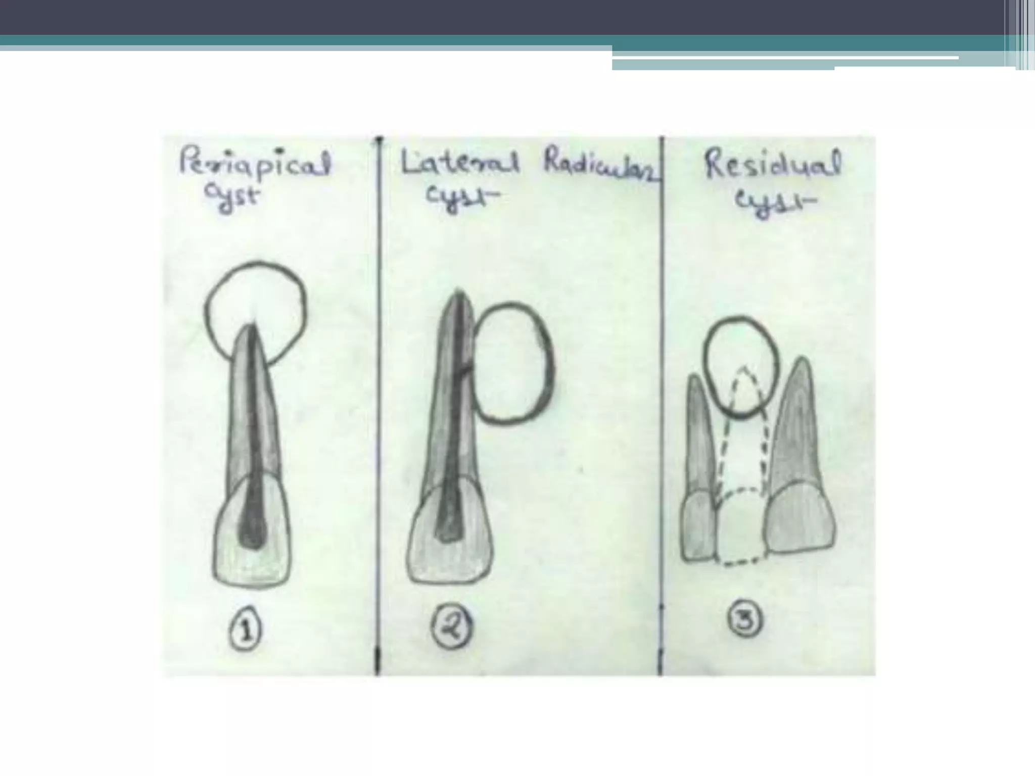 Radicular cyst (maryam arbab) | PPTX