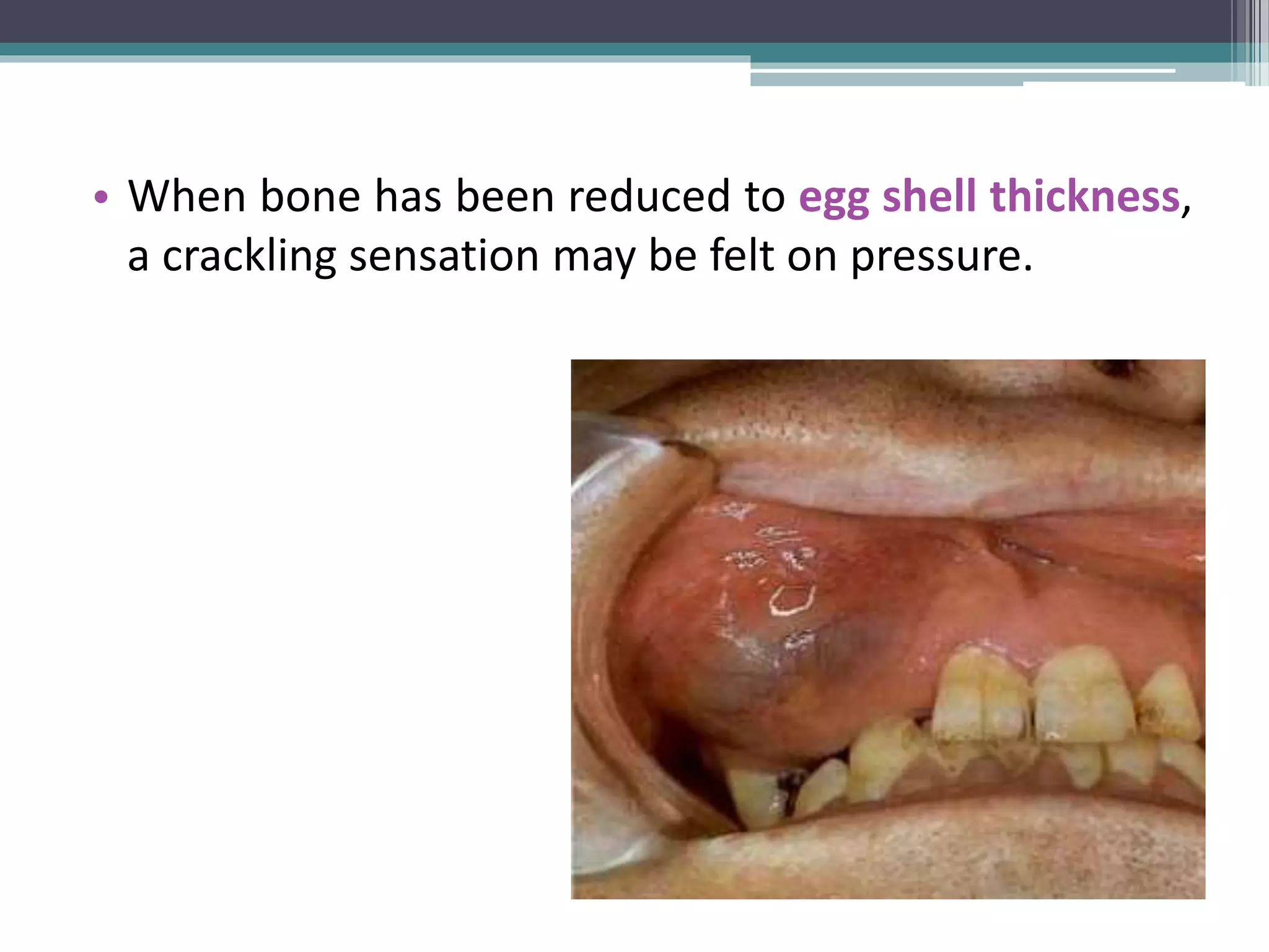 Radicular cyst (maryam arbab) | PPTX