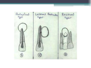 Lateral Radicular Cyst