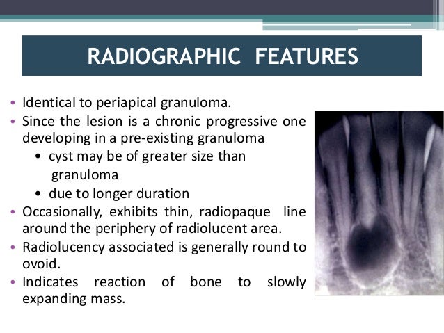 Radicular cyst (maryam arbab)