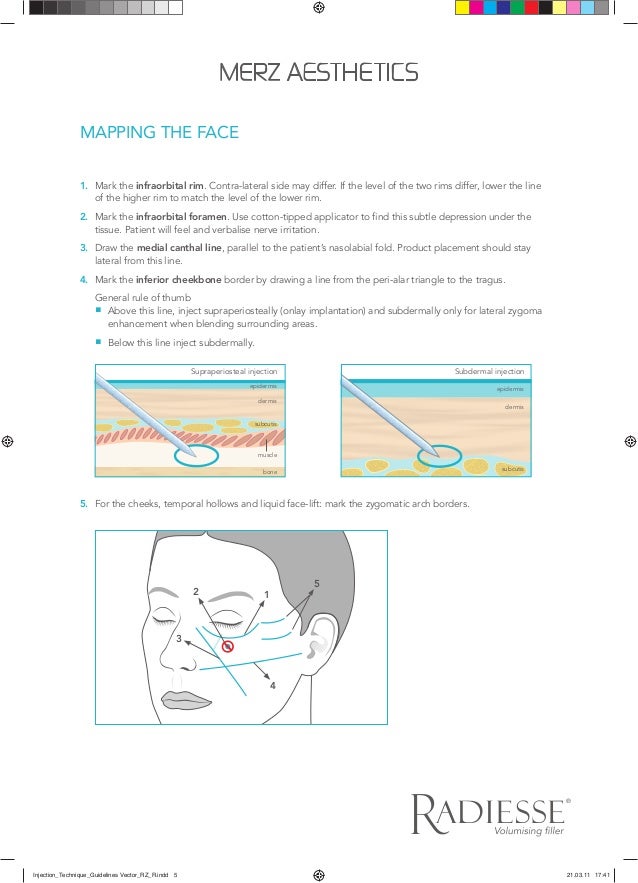 Radiesse Injection Vectoring