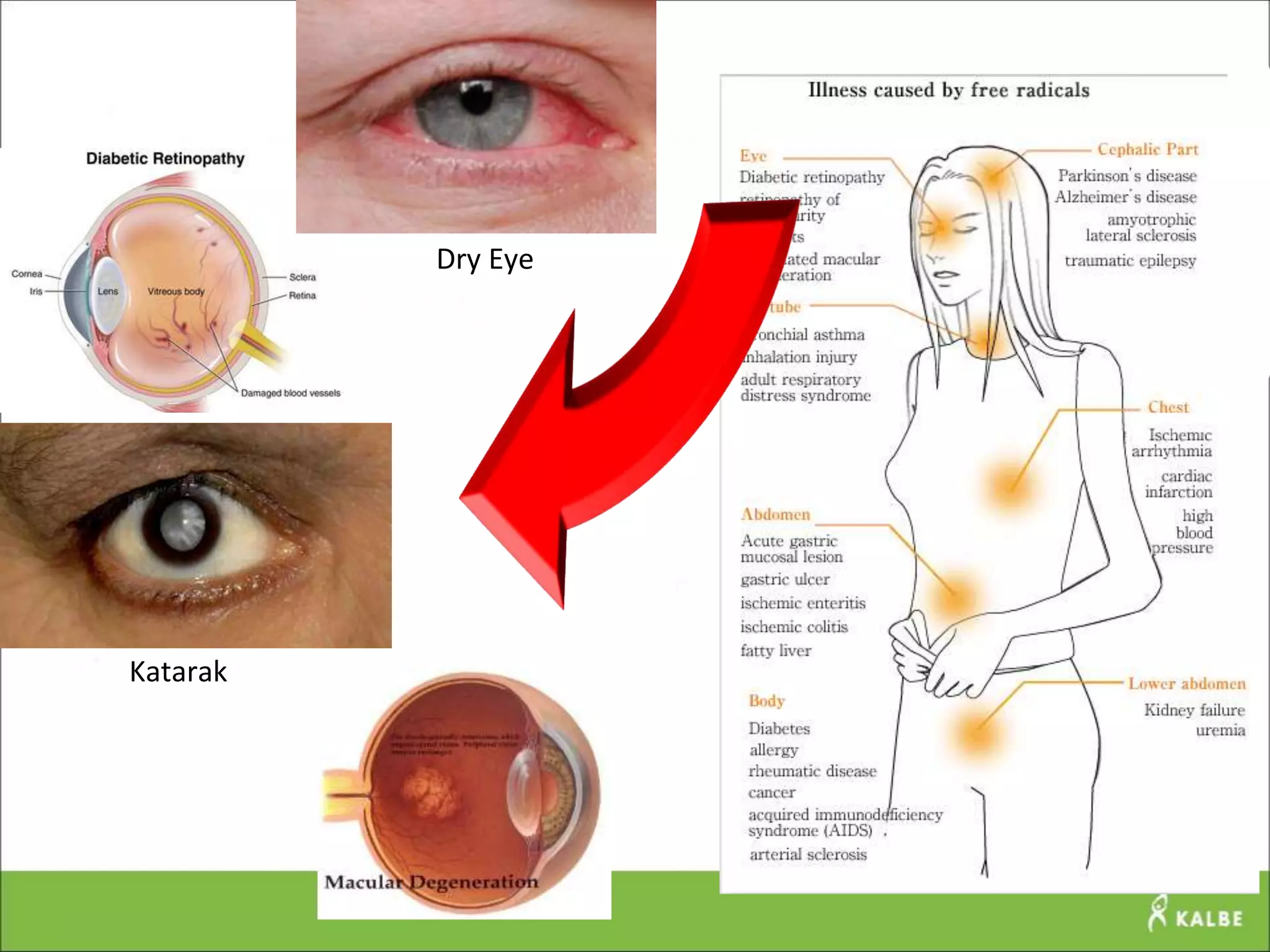 Radikal bebas vs Antioksidan.pptx
