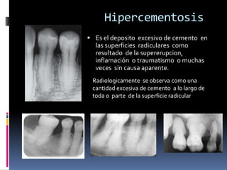 caries y ligamento periodontal radiologicamente | PPTX
