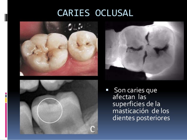 caries y ligamento periodontal radiologicamente