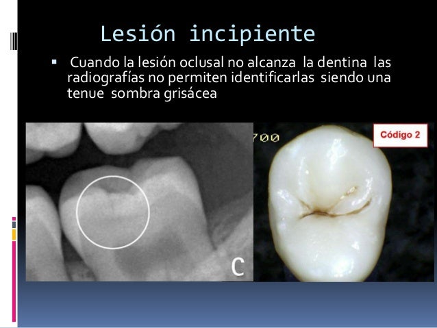 caries y ligamento periodontal radiologicamente
