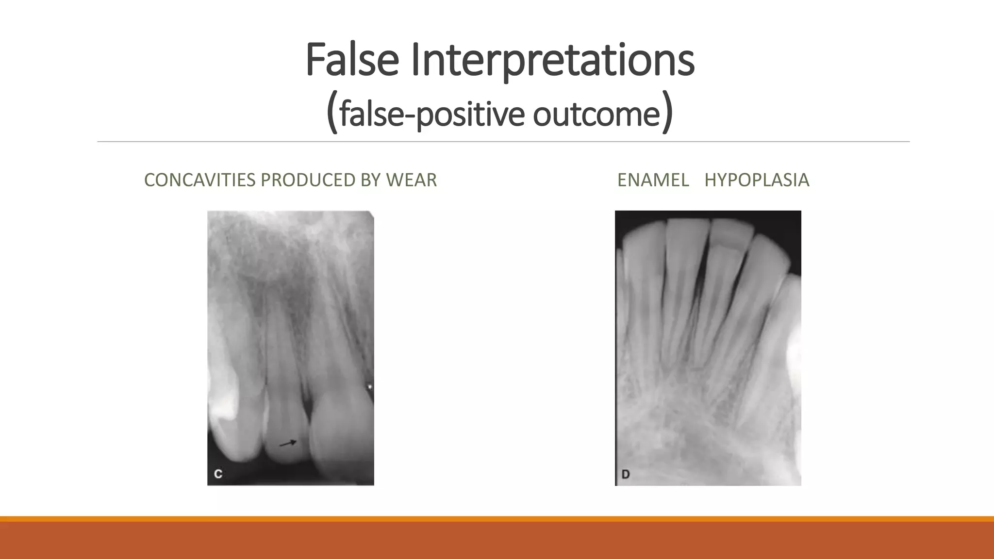 radiographic of interpretation of dental caries | PPTX